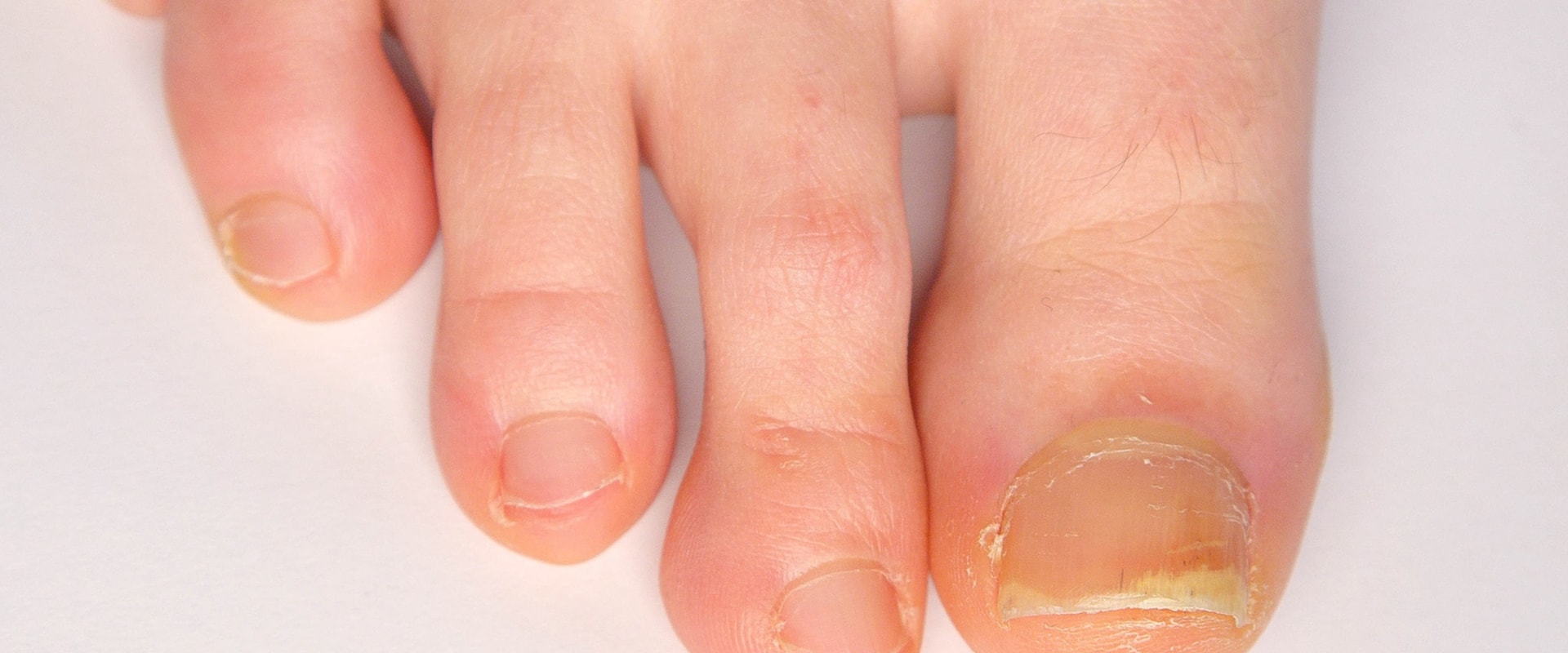 Expert Tips for Cutting Thick Toenails: A Podiatrist's Perspective